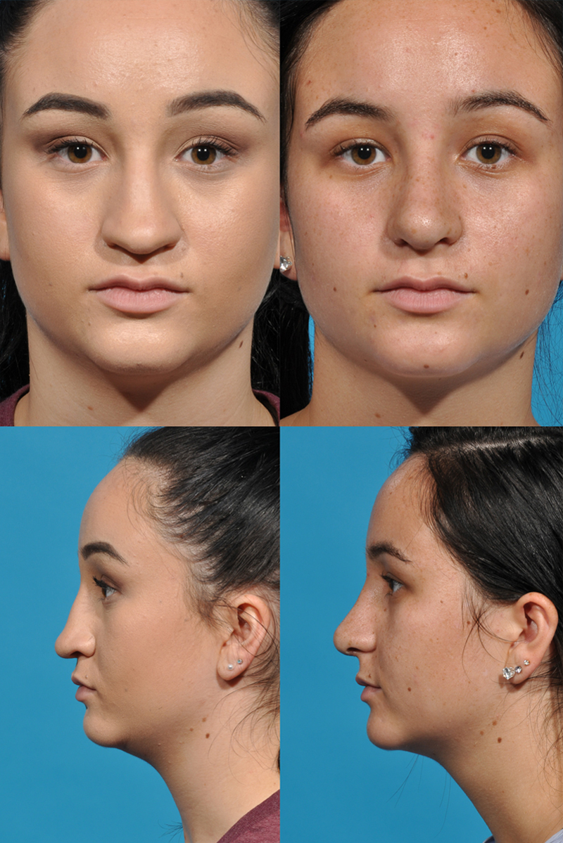 Results-Rhinoplasty – Aesthetic Specialists