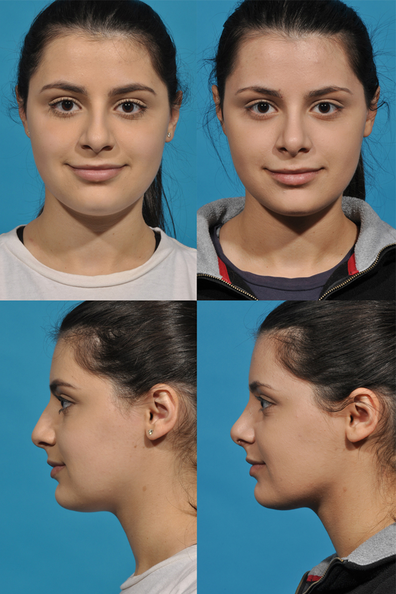 Results-Rhinoplasty – Aesthetic Specialists